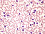 Hairy cell leukemia: variant