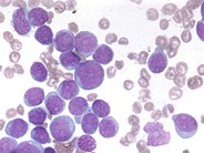 Acute Myeloid Leukemia without Maturation - 1.