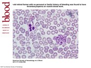 Leukoagglutination reported as platelet clumps
