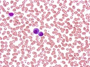 Amyloidosis: Acquired Factor X Deficiency - 1.