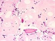 Amyloidosis: Acquired Factor X Deficiency - 1.