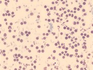 Clumps of platelets in peripheral blood smear
