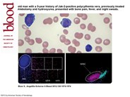 Block of red blood cell maturation in acute erythroid leukemia