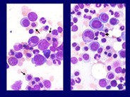 Myeloid Neoplasms. Myelodysplastic Syndrome: Refractory Ctyopenia with ...