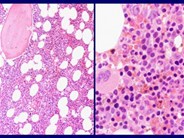 Myelodysplastic Syndrome: Refractory Anemia with Ringed Sideroblasts ...