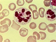 Hypersegmented poly in PA