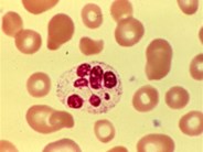 Hypersegmented poly in PA