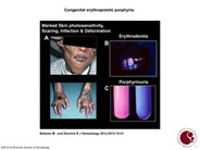 Skin lesions in porpyria cutanea tarda