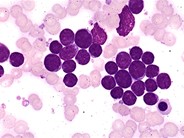 Precusor B-cell Acute Lymphoblastic Leukemia - 2.