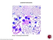 Myeloid leukocytosis
