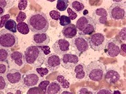 Microgranular Variant of Acute Promyelocytic Leukemia - 1.