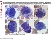 Chediak-Higashi–like granules within leukemic promyelocytes