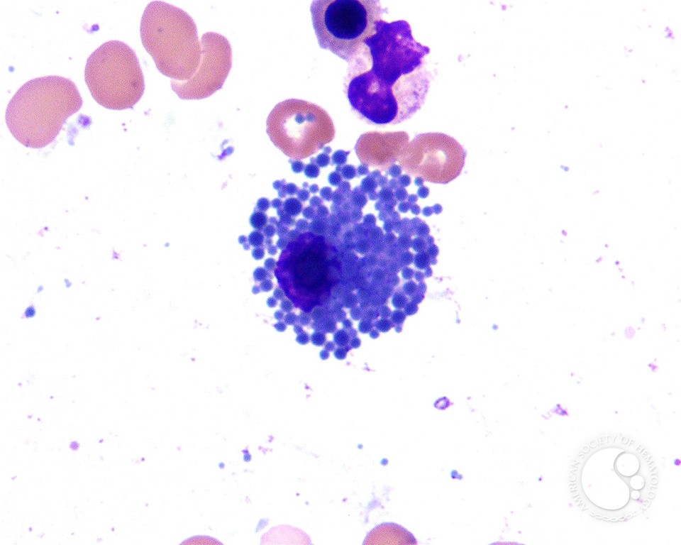 Plasma Cell Inclusions - 2. Plasma Cell Inclusions - 2.