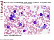 Nuclear hypersegmentation of neutrophils, eosinophils, and basophils ...