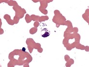 Signet-ring histiocytes in typhoid fever