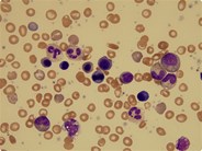 Parvovirus infection mimicking a myeloproliferative neoplasm in a ...