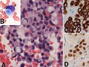 Metastatic lobular breast carcinoma mimicking multiple myeloma