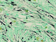 Bone Marrow Fibrosis - 6.