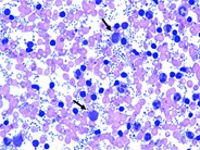 Sézary Cells - 1.