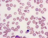 Pappenheimer Bodies in Sickle Cell Disease - 2.