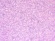 Diffuse large B-cell lymphoma, T-cell/histiocyte rich variant - lymph ...