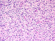 Diffuse large B-cell lymphoma, T-cell/histiocyte rich variant - lymph ...