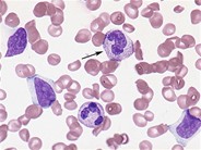 Toxic granulation - 1.