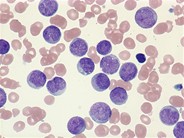 Cryoglobulins in a patient with Multiple Myeloma