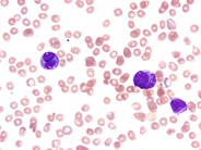 AML with t(15;17)(q22;q21), microgranular variant - 1.