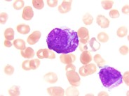 AML with t(15;17)(q22;q21), microgranular variant - 1.
