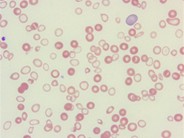 RBC morphology in thalassemia - 4.