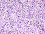 Diffuse Large B-cell Lymphoma, Anaplastic Variant - 2.