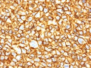 Diffuse Large B-cell Lymphoma, Anaplastic Variant - 3.