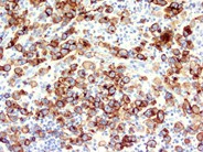 Diffuse Large B-cell Lymphoma, Anaplastic Variant - 3.