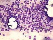 T-cell lymphoblastic leukemia - 2.