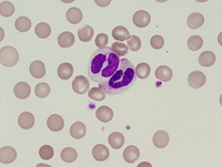 Atypical chronic myeloid leukemia, BCR-ABL1 negative 1