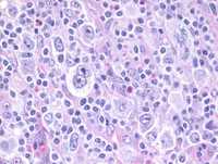 Reed Sternberg Cells 2