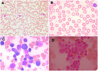 Refractory anemia with ring sideroblasts associated with thrombocytosis ...
