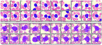 Digital imaging of peripheral blood identifies atypical chronic ...