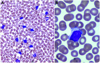 Abnormal lymphocytes with “filamentous-like” cytoplasmic inclusions in ...