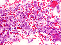 Langerhans cell histiocytosis touch prep