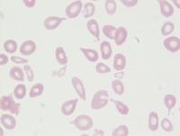 Tear drop cells (Dacrocytes) 2