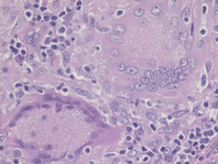 Sarcoidosis Granulomas and Giant cells