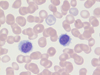 Hairy Cell Leukemia