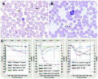 Abnormalities of platelet aggregation associated with giant granules in ...
