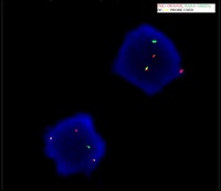 FISH showing t(15;17)(q24;q21), PML/RARA TRANSLOCATION