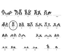 CMML-1 with monosomy 7 by karyotyping