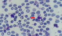 Giant Platelet in a Patient with Thrombocytosis