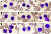Internuclear bridging outside of primary myelodysplasia and congenital ...
