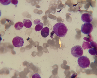 ALL patient taking G-CSF medication shows a myeloproliferative bone ...